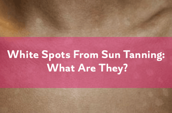 White spots from sun tanning: What are they? – Tan Junkie